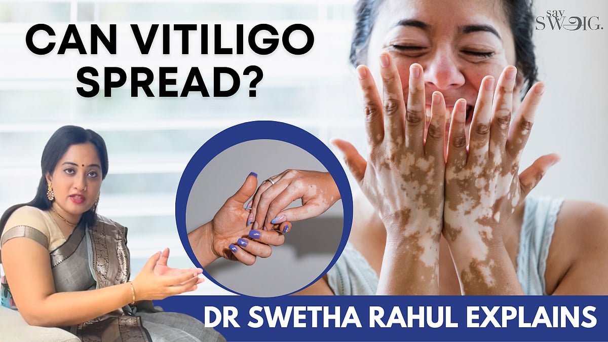 இந்த வயசுலதான் Vitiligo அதிகமா வரும்; அத Cure பண்ண முடியுமா? - Dr ...
